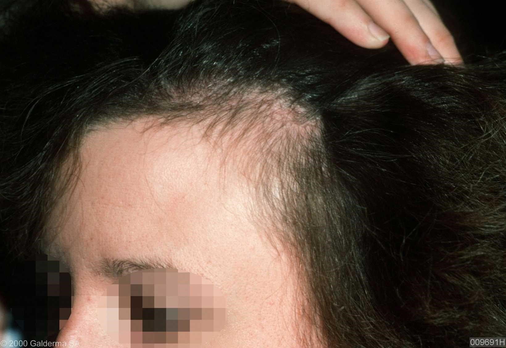 Telogen Effluvium Regrowth Pictures Photos