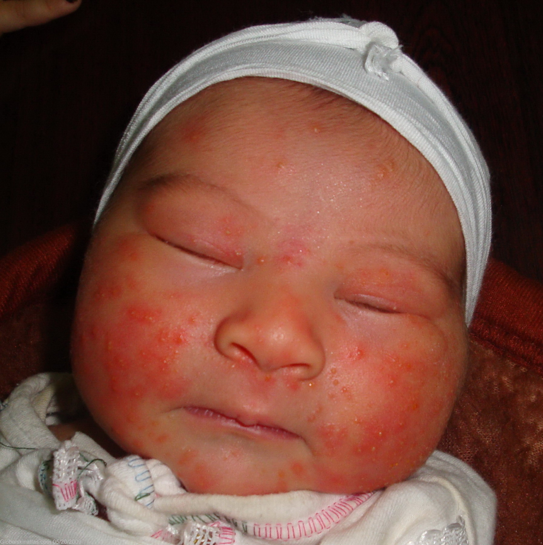 neonatal acne - pictures, photos