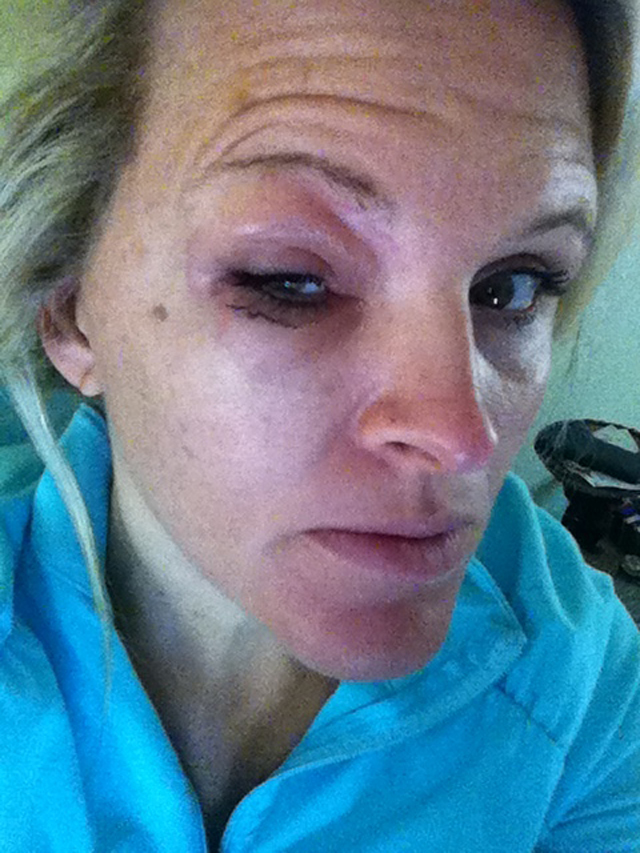 Red Rash Under Eyes Pictures Photos red-rash-under-eyes-pictures-photos