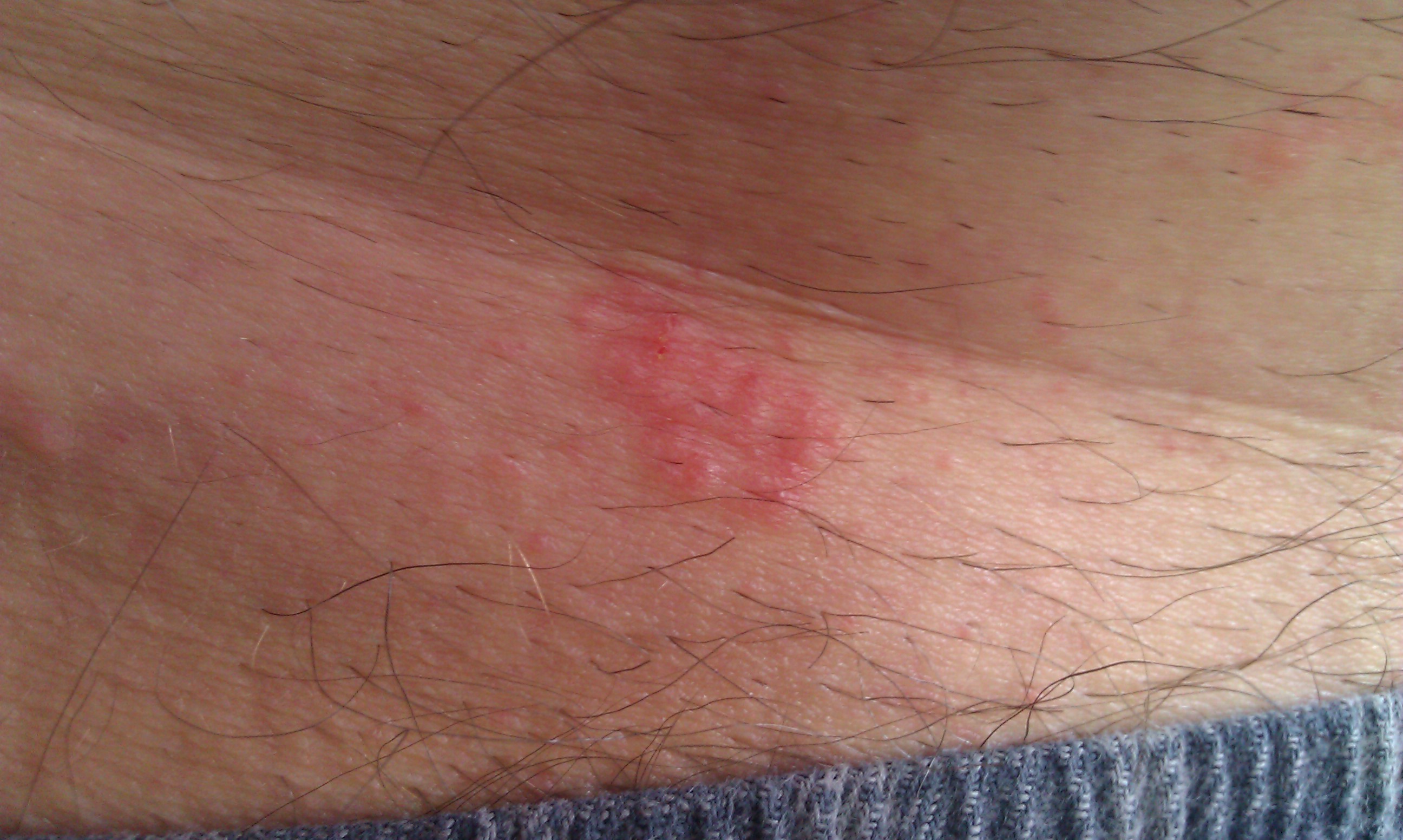 Itchy Bumps On Back Of Hands Pictures Photos itchy-bumps-on-back-of-hands-pictures-photos