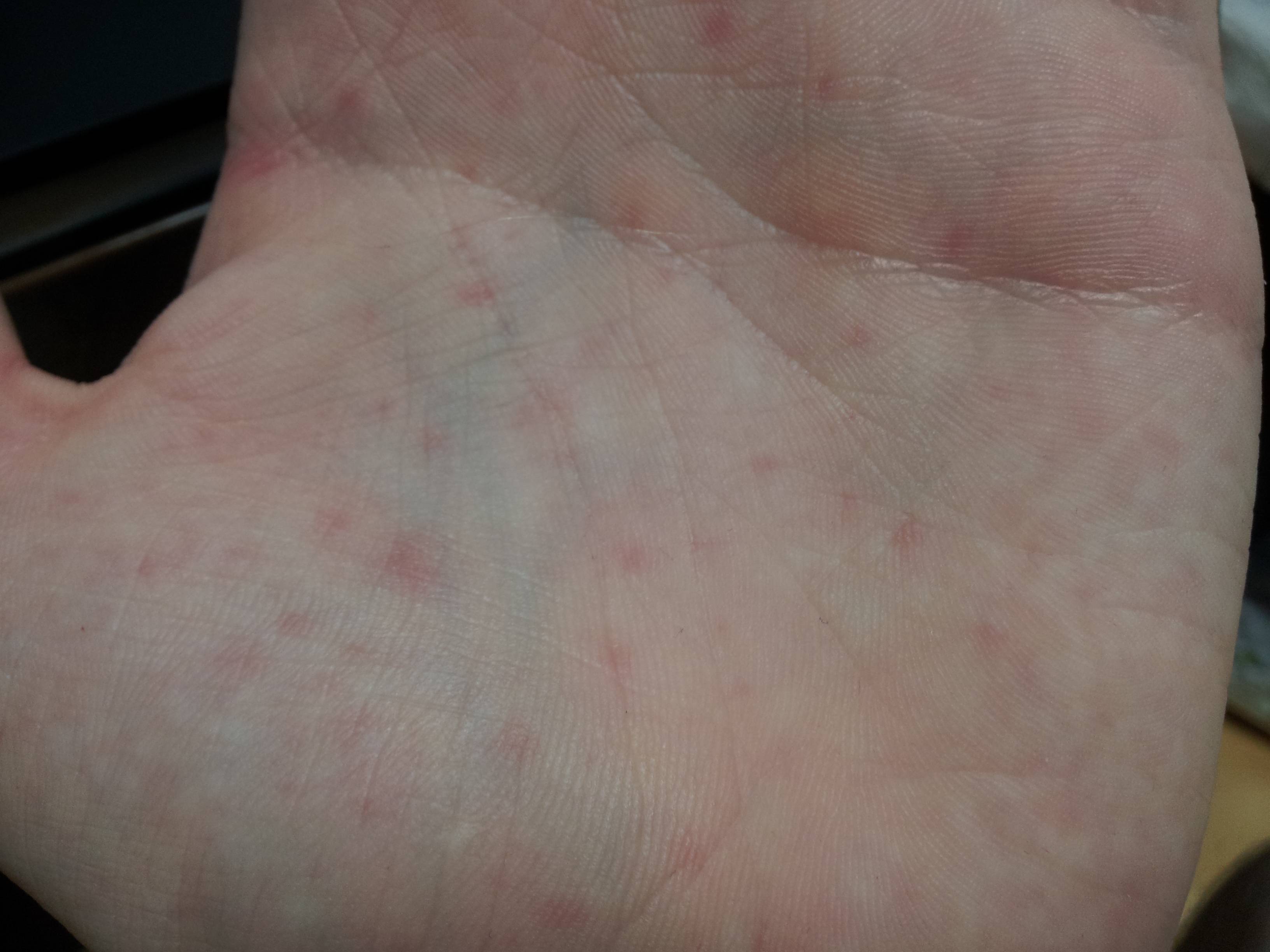 Red Spots On Palms Of Hands Pictures Photos red-spots-on-palms-of-hands-pictures-photos
