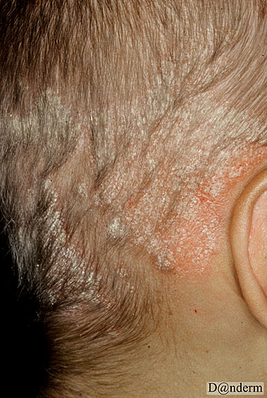 Psoriasis Of Scalp Pictures Photos