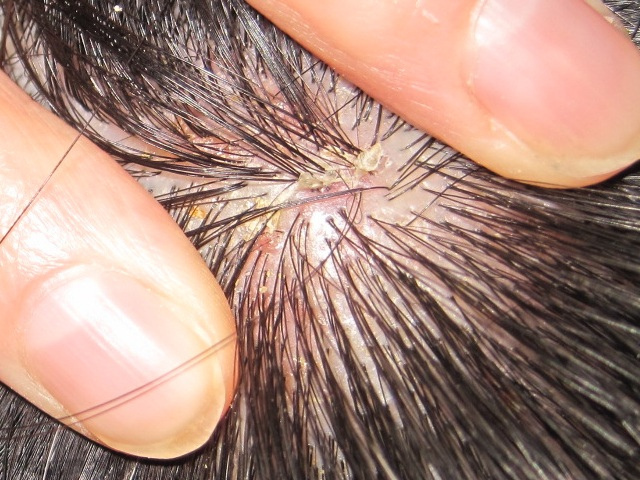 Scalp Rashes Pictures Photos