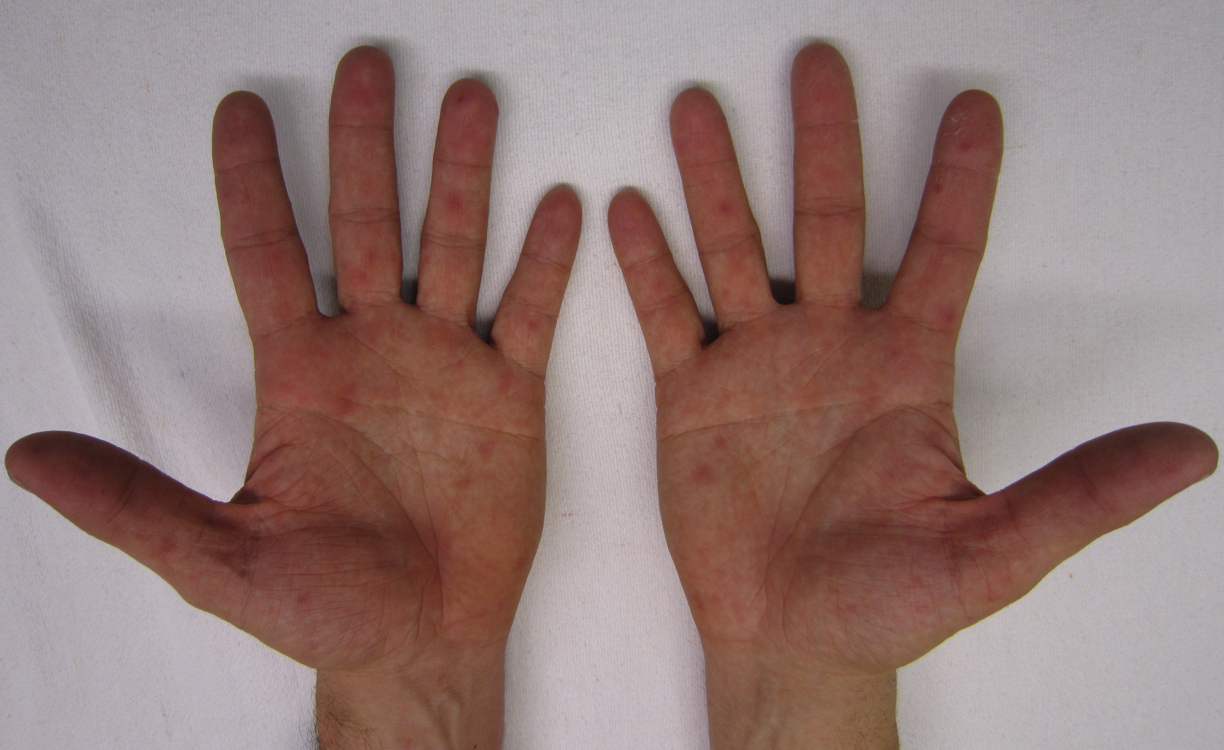 Rash On Hand And Foot Pictures Photos