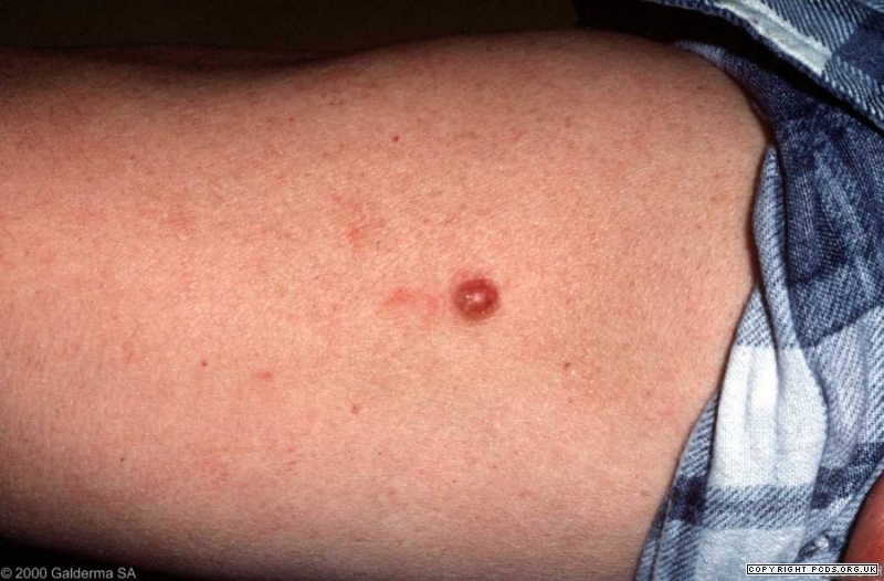 Cutaneous Leiomyoma Pictures Photos