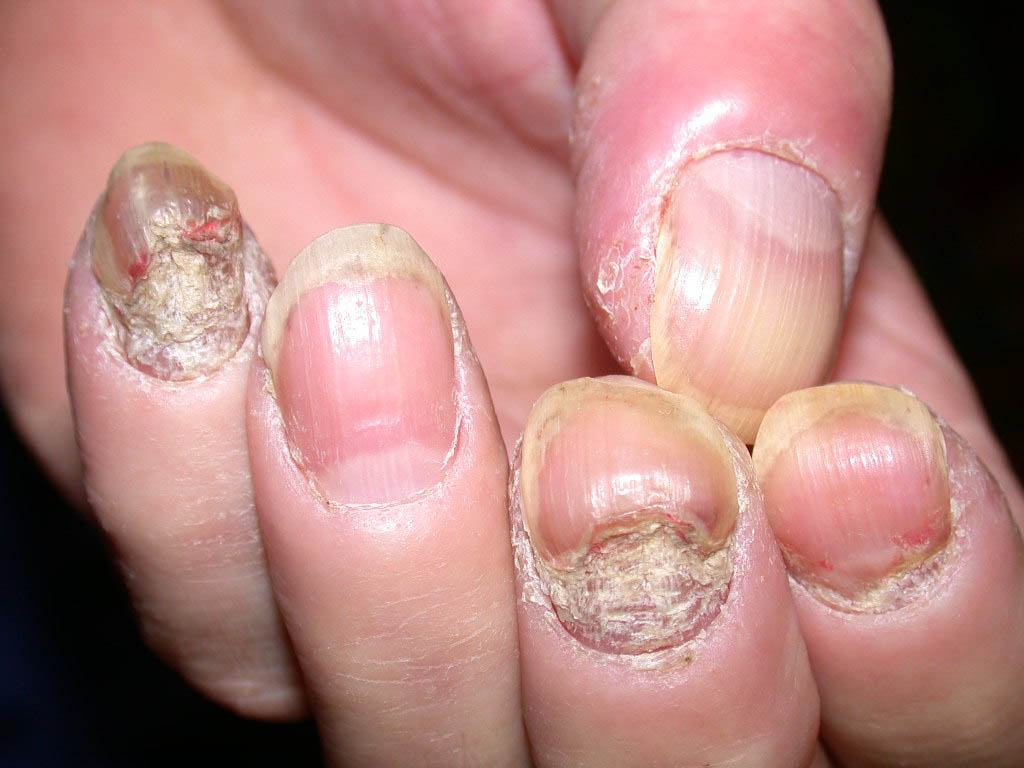 Nail Psoriasis Pictures Photos