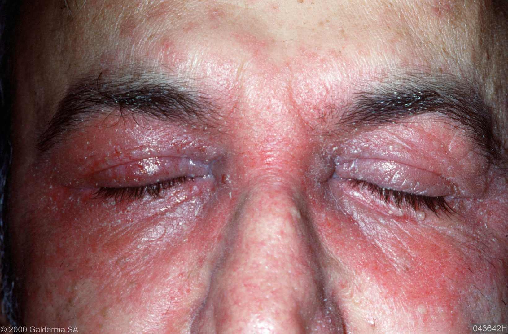 dermatomyositis pictures - pictures, photos