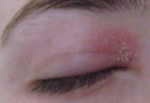 Flaky Eyelids Pictures Photos flaky-eyelids-pictures-photos