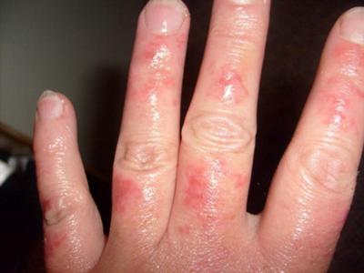 rash on fingertips - pictures, photos