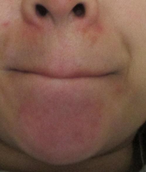 Redness Around Nose Pictures Photos redness-around-nose-pictures-photos